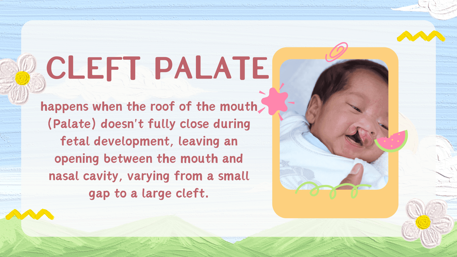 Cleft Lip And Palate Ppt Nursing Students - Infoupdate.org